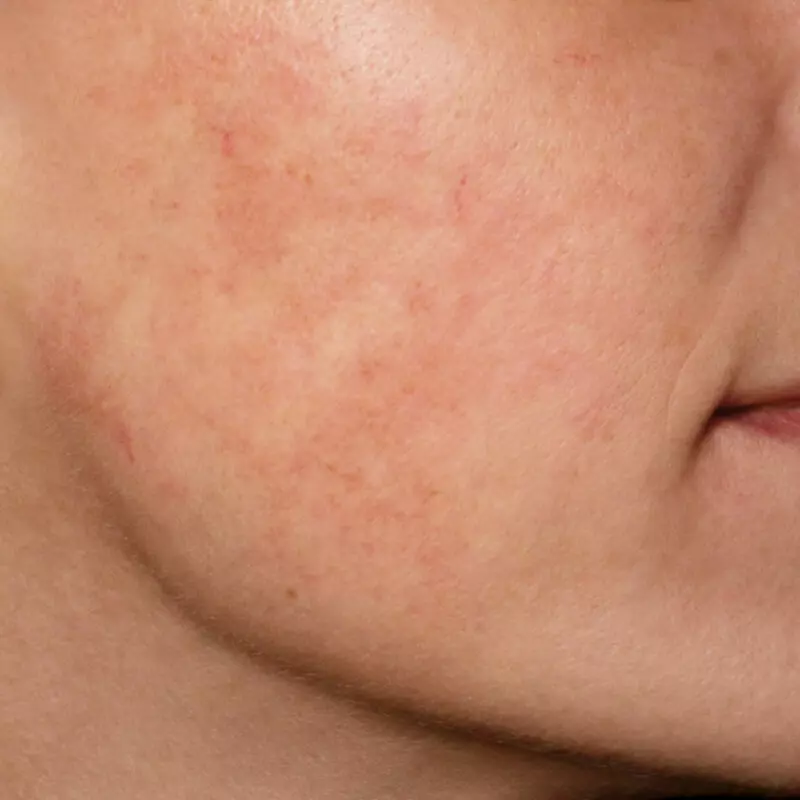 El proceso de regeneración de la piel | LE PURE