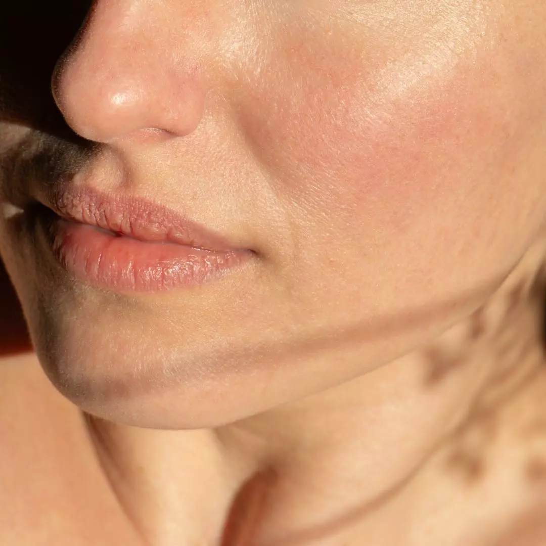 Treatment for Fragile Capillaries | LE PURE